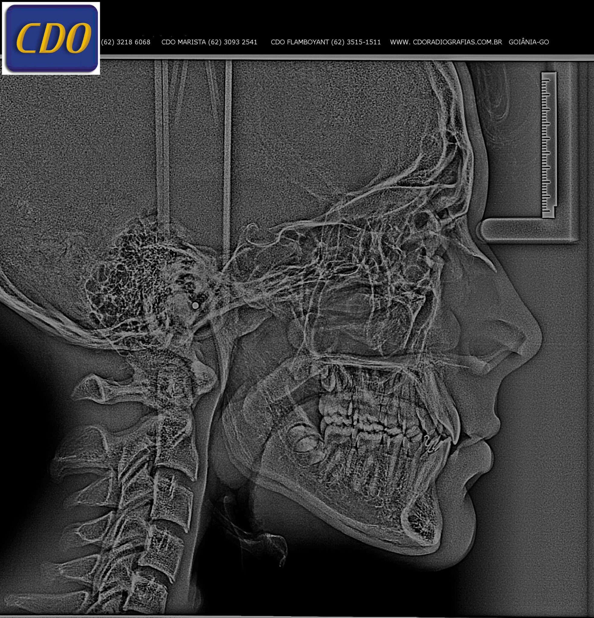 RADIOGRAFIAS INTRA E EXTRABUCAIS – CDO Radiografias
